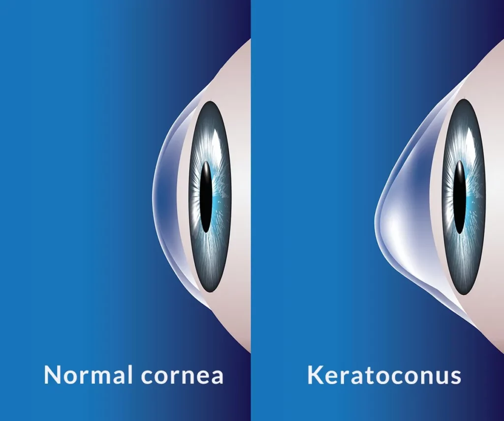Eye Rubbing and Keratoconus | Corsini Laser Eye Center